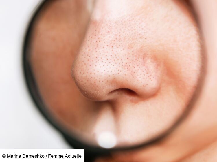 Points noirs : le geste à éviter absolument (et par quoi le remplacer ...