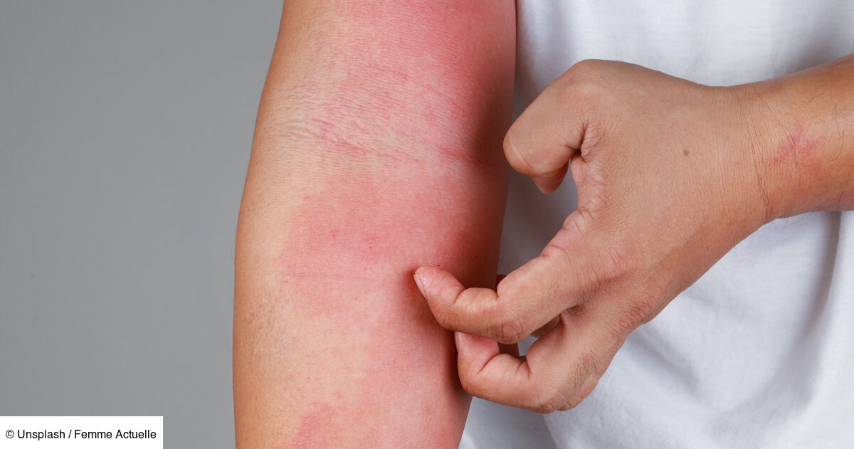 Quand s'inquiéter d'une crise d'urticaire : les symptômes qui doivent ...