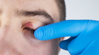 Angine : virale, blanche ou rouge, symptômes, durée et traitements ...