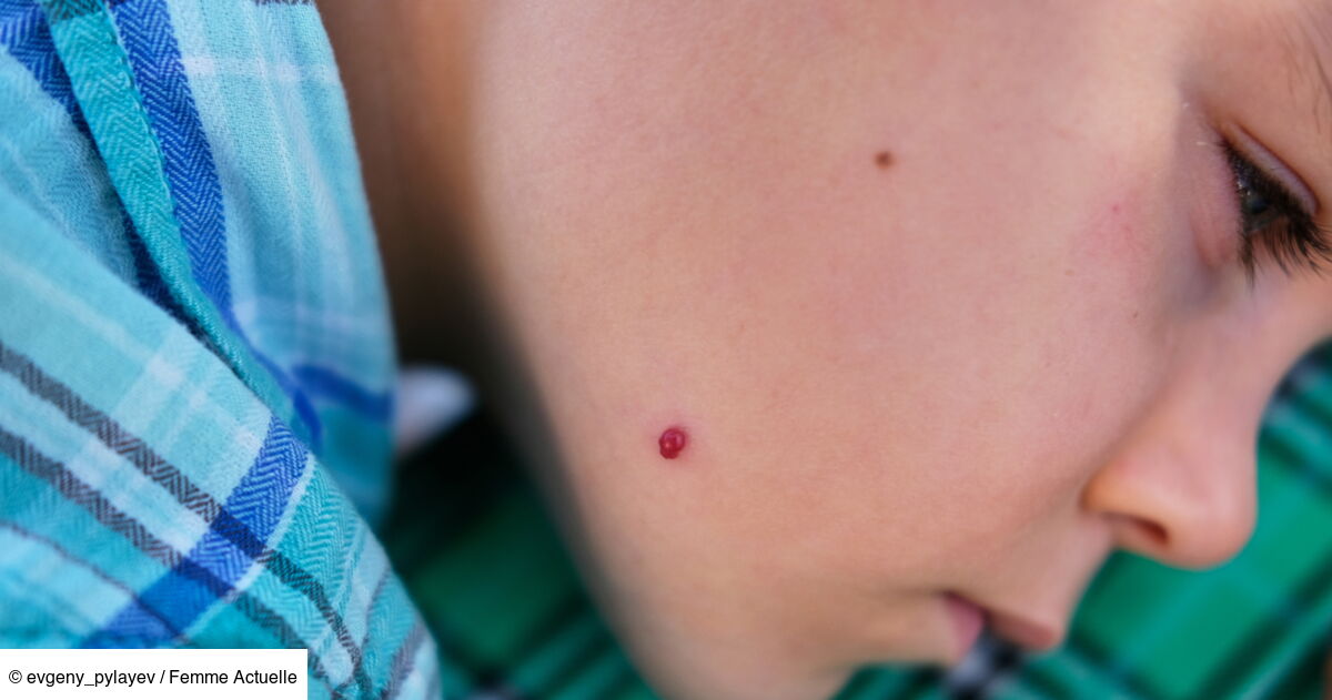 Angiome : définition, causes, comment le reconnaître : Femme Actuelle ...