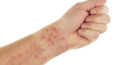 Nécrose : causes, symptômes, différents types, traitements : Femme ...