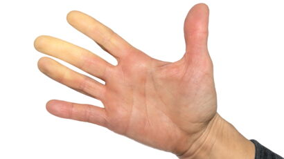 Ulcères variqueux : causes, symptômes, complications, traitement ...