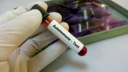 Lupus : les premiers symptômes de cette maladie auto-immune : Femme ...