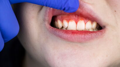 Uncarthrose : causes, symptômes, traitement de l'arthrose ...