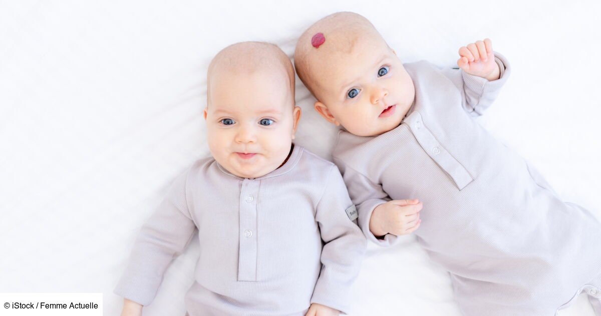 Angiome de bébé : causes, traitements, faut-il s'inquiéter ? : Femme ...