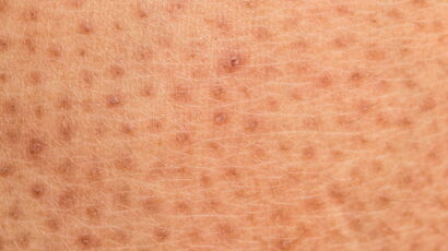 Prurigo : causes, symptômes et traitements de cette maladie de peau ...