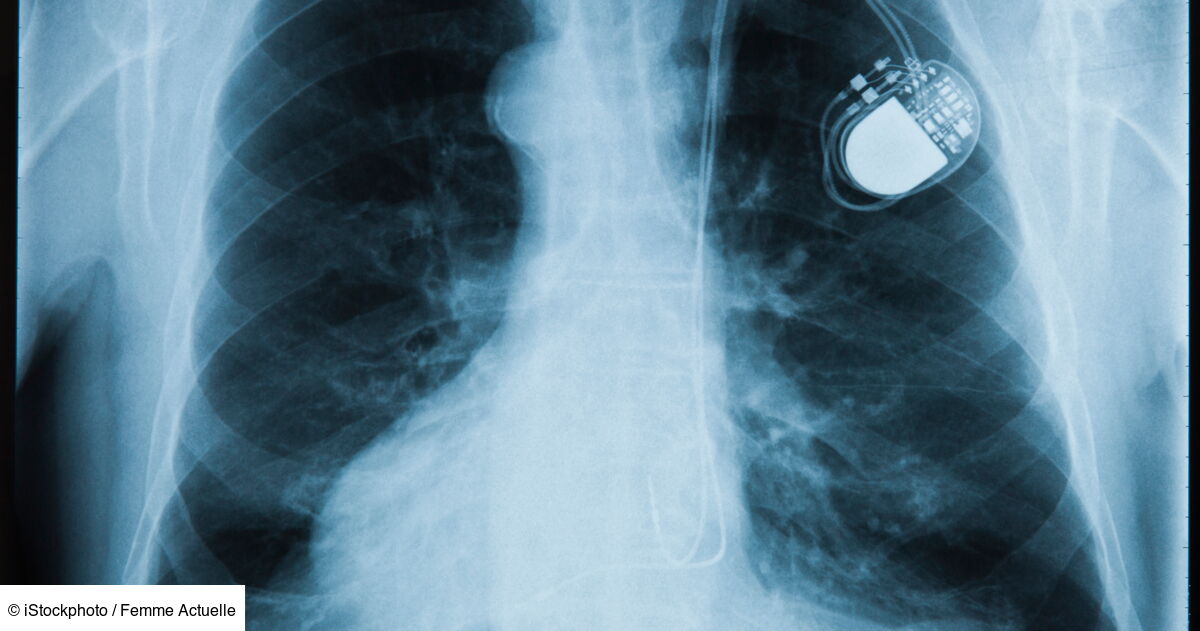 Peut On Conduire Apres La Pose D Un Pacemaker