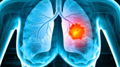 Cancer du poumon : comment en guérit-on ? Les traitements disponibles : Femme Actuelle Le MAG