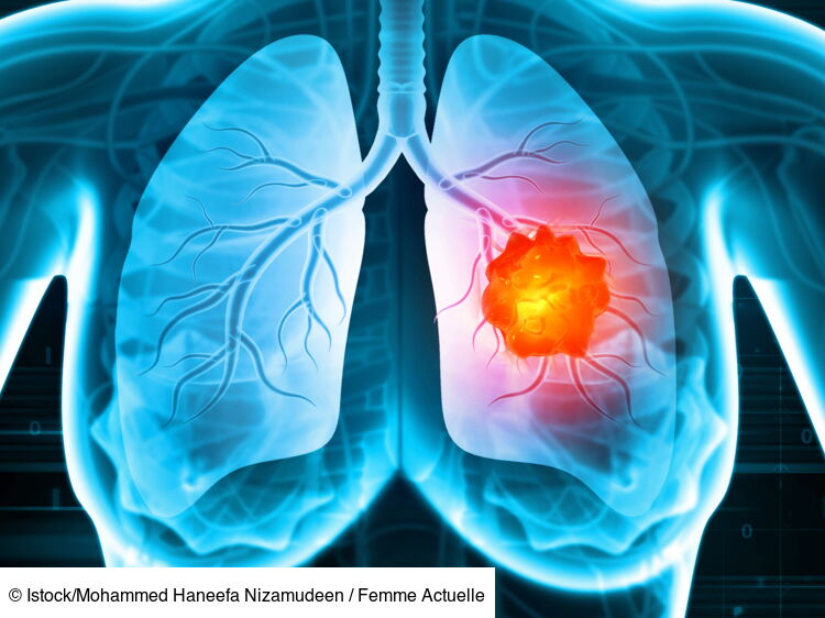 Traitements du cancer du poumon : comment se soigne-t-il selon le stade ? : Femme Actuelle Le MAG