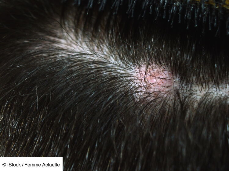 Kyste sébacé : comment enlever un kyste ? : Femme Actuelle Le MAG