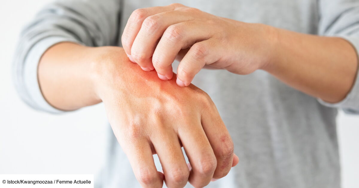 Syndrome de Sézary : symptômes et traitements de ce lymphome cutané ...