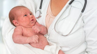 Pieds-mains-bouche : comment reconnaître ces boutons caractéristiques ...