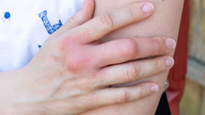 Piqûre de fourmi : comment la reconnaître et que faire ? : Femme ...