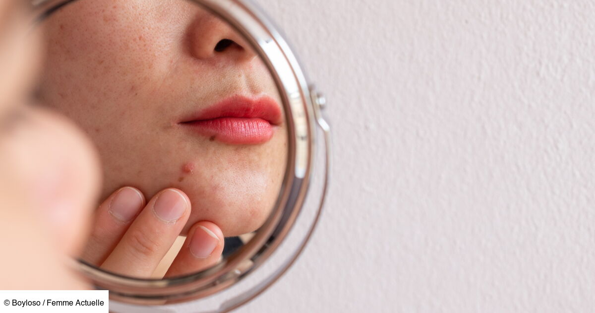 Poussée soudaine de boutons sur le corps : quand s'inquiéter d'une ...