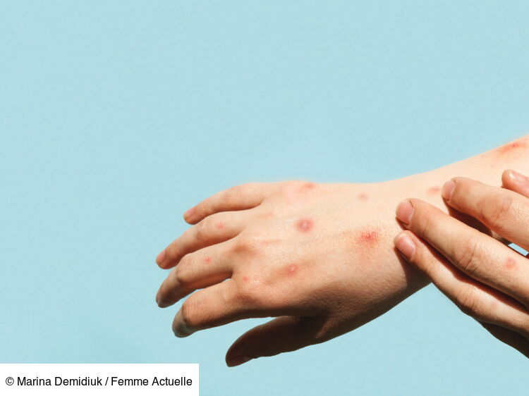 Varicelle chez l’adulte : comment reconnaître les symptômes ? : Femme ...