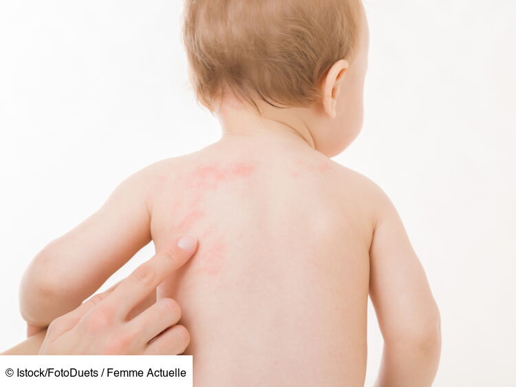 Comment reconnaître l’urticaire chez bébé ? : Femme Actuelle Le MAG