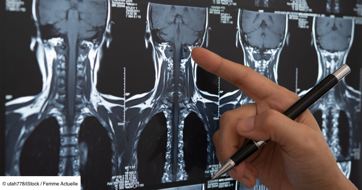 Signe de Lhermitte : de quoi s’agit-il et dans quelles pathologies peut ...