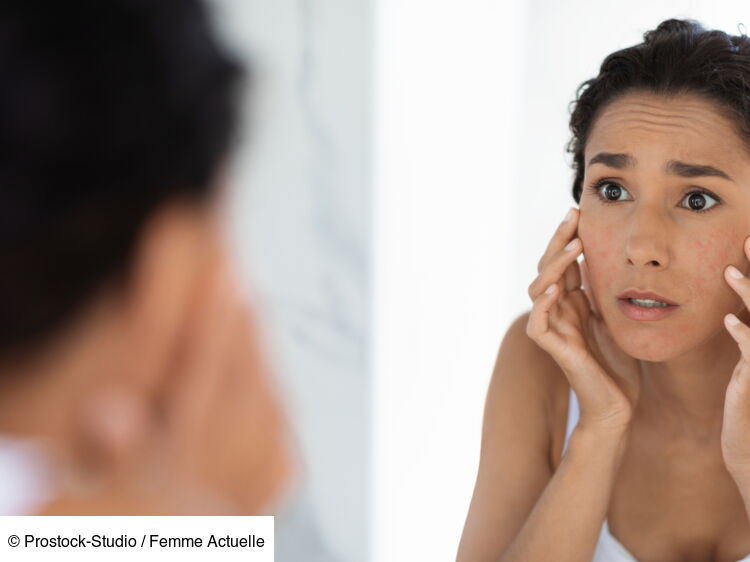 Eczéma ou urticaire, quelle est la différence ? : Femme Actuelle Le MAG