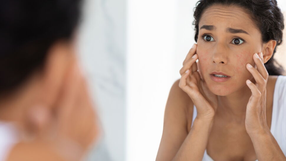 “Voici comment prévenir et atténuer les taches d’acné”, une ...