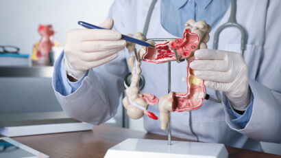 Colite ulcéreuse : causes et symptôme de cette inflammation du gros ...