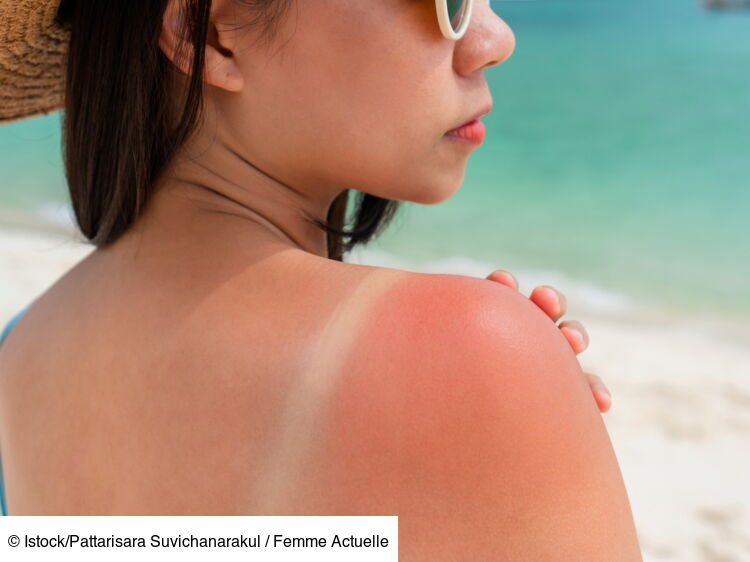 Comment soulager naturellement un coup de soleil (et éviter de peler) ? : Femme Actuelle Le MAG