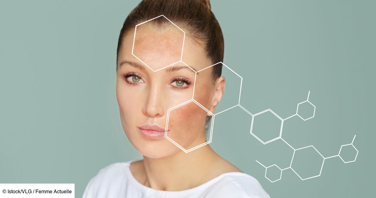 Tache mongoloïde : comment reconnaître ces taches de naissance ...