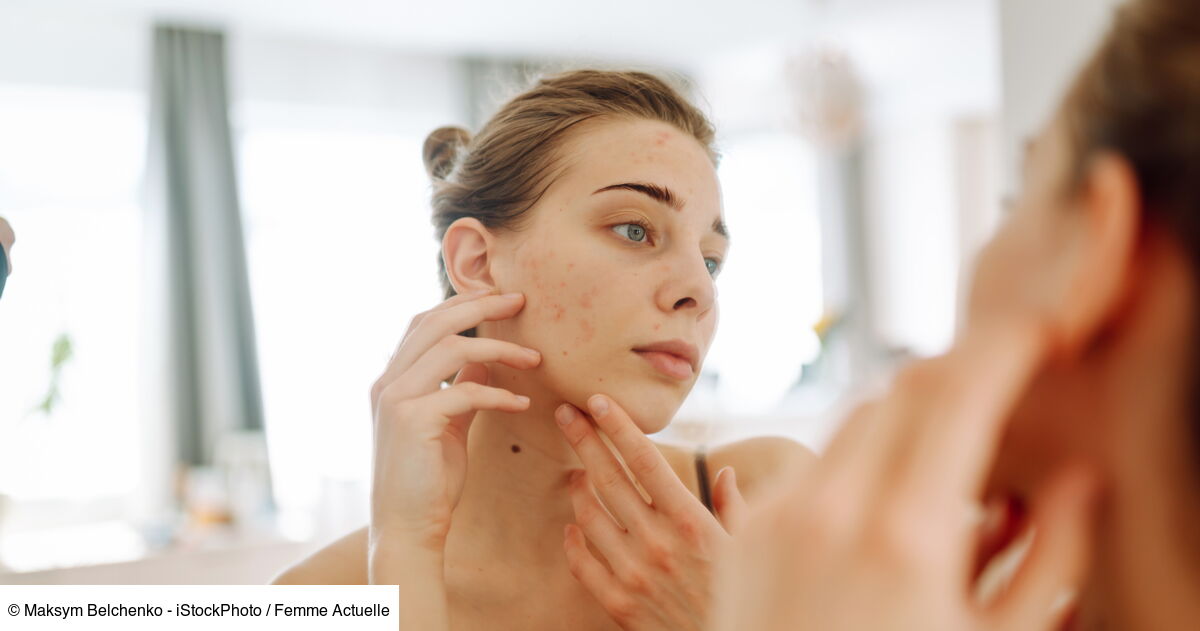 Qu'est-ce que la démodécidose, cette affection cutanée rare proche de ...