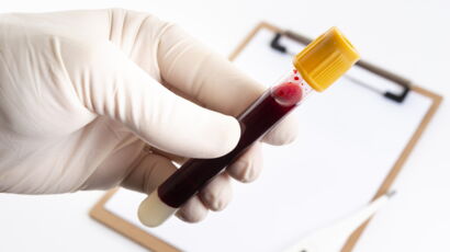 Dosage de l'urée : trop élevée ou trop basse, quelles sont les causes ...