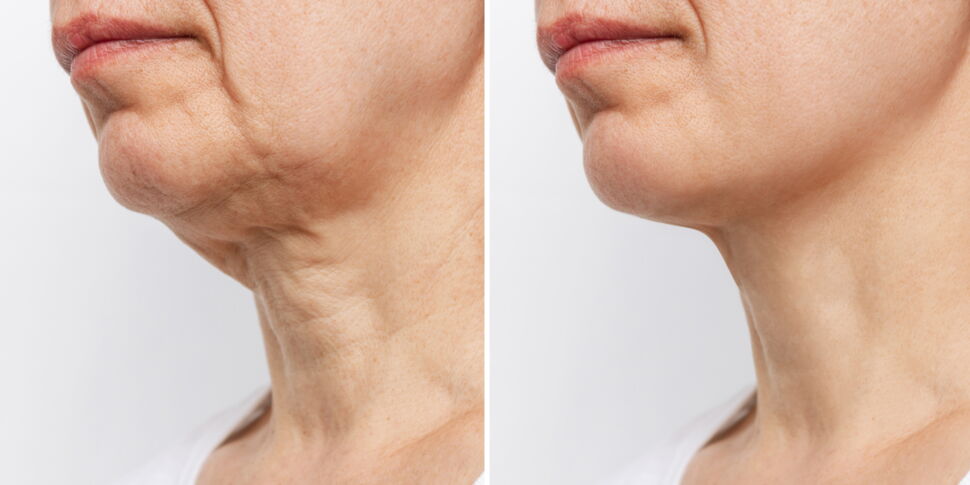 Relâchement du cou : voici les ingrédients qui marchent vraiment pour l ...