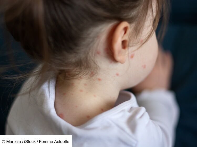Une recrudescence des cas de rougeole dans les "semaines à venir ...