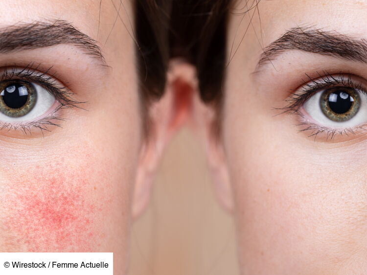 Acné, psoriasis, rosacée : ces 7 aliments accentuent ces problèmes de ...