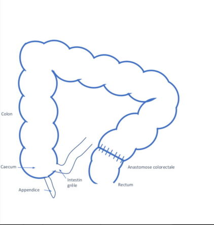 Sigmoïdectomie : technique chirurgicale, déroulement et conséquences de ...